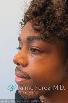 Rhinoplasty Case 1978 - Plastic Surgery Center of Tampa - Jaime Perez, MD